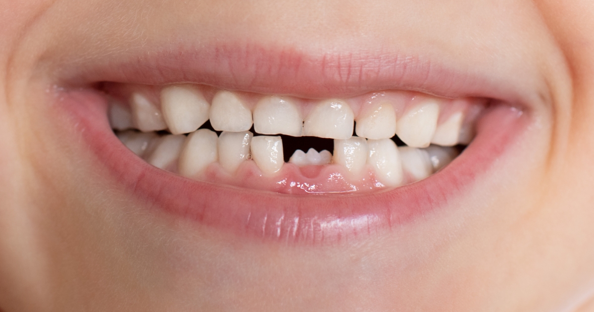 How to Fix a Cracked Tooth Naturally: Simple Remedies That Work