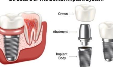 Transform Your Smile with Dental Implants in Boynton Beach